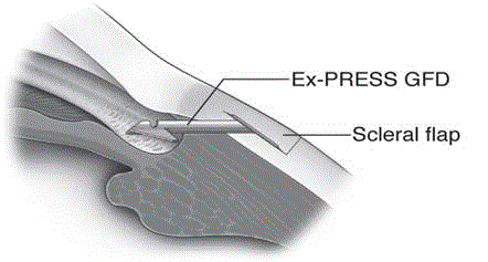 Long Term Results of the Ex-PRESS P-200 Miniature Glaucoma Filtration ...